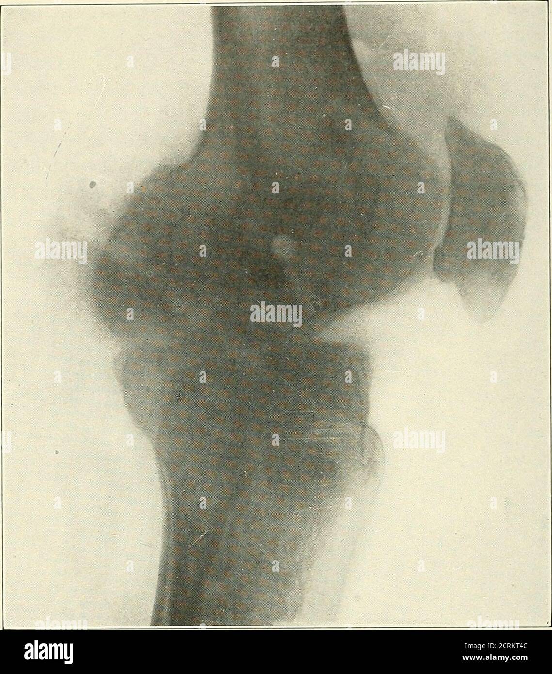 Bone Spurs High Resolution Stock Photography and Images - Alamy