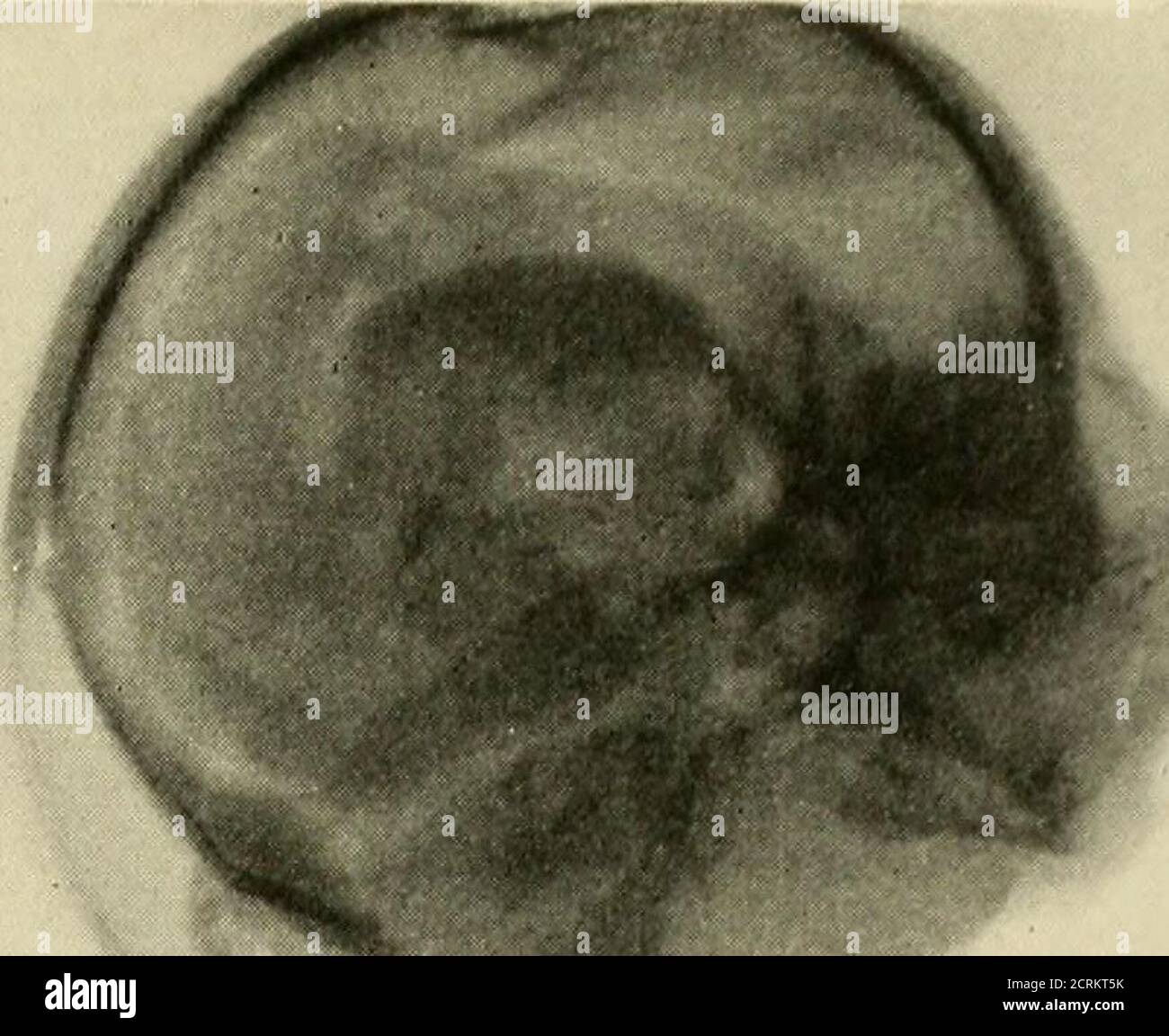 . Röntgen ray diagnosis and therapy . Fig. 92.—Embryo of Ten Weeks ...