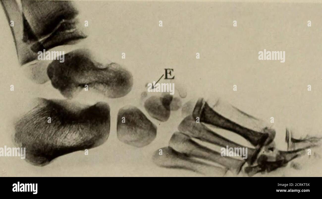 . Living anatomy and pathology; . *. PLATE 23.NORMAL SPINE. Age 10 ...
