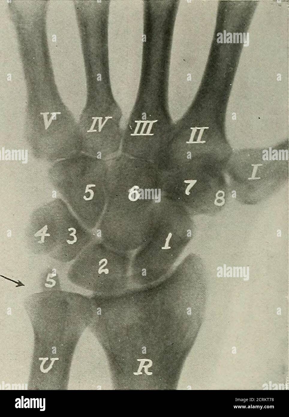 Styloid fracture hi-res stock photography and images - Alamy