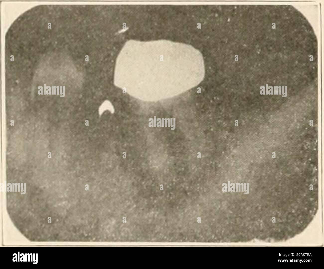 . Interpretation of dental & maxillary roentgenograms . Fig. 194. Fig ...
