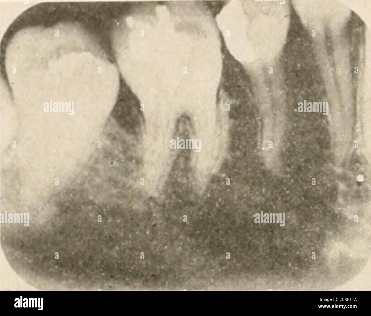 . Interpretation of dental & maxillary roentgenograms . Fig. 192. Fig ...
