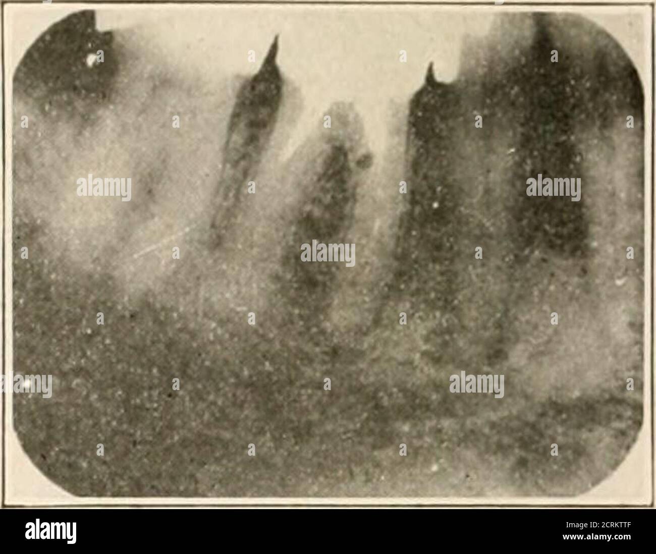 . Interpretation of dental & maxillary roentgenograms . Fig. 194. Fig ...