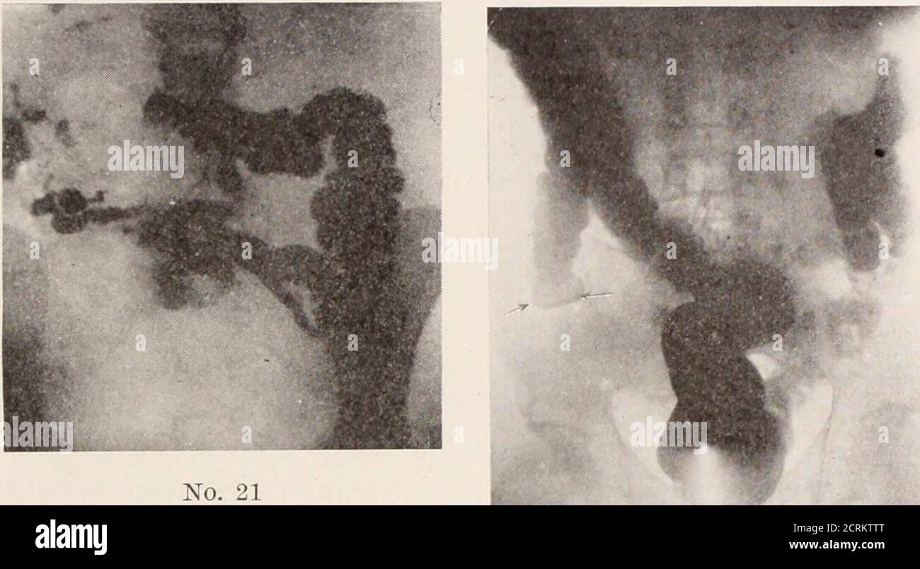 . Journal of roentgenology . No. 18 No. 20 Filling Defect Due to Lympho ...