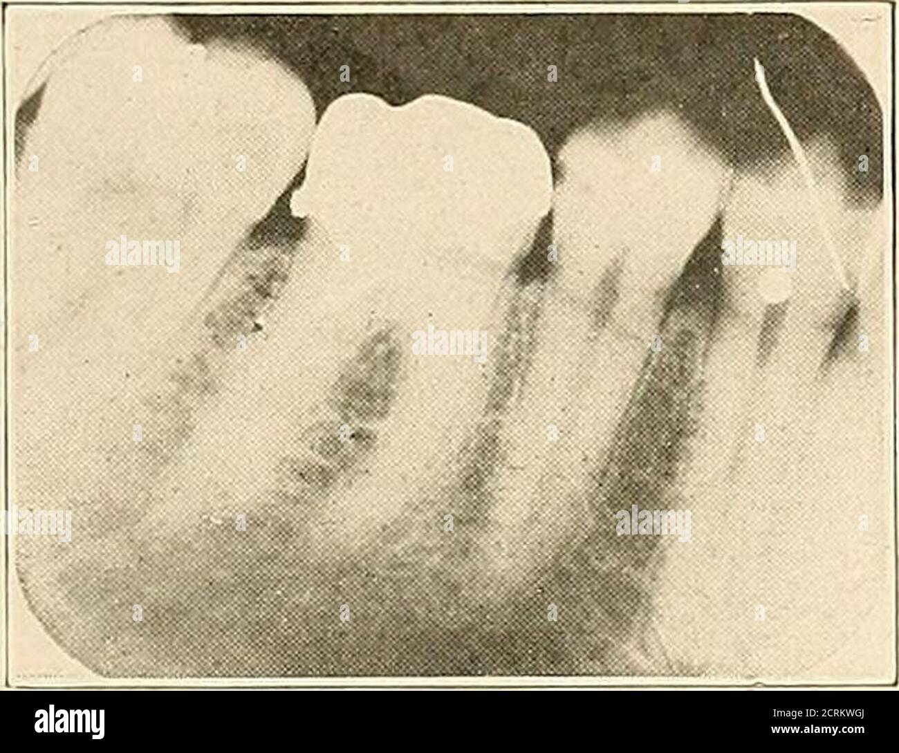 . Interpretation of dental & maxillary roentgenograms . Fig. 188. Fig ...