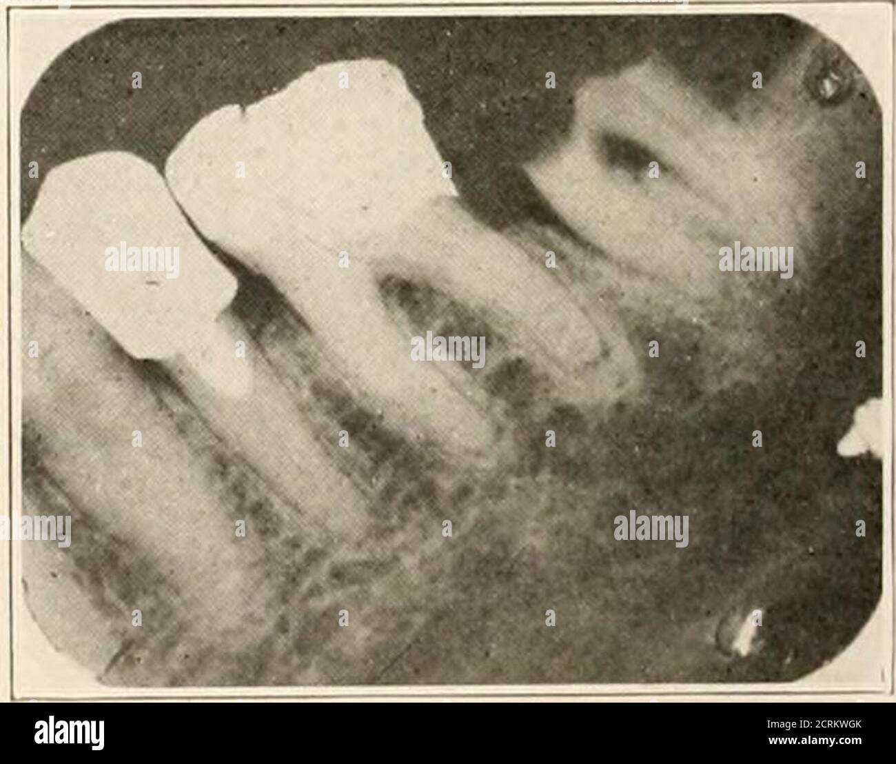 . Interpretation of dental & maxillary roentgenograms . Fig. 188. Fig ...
