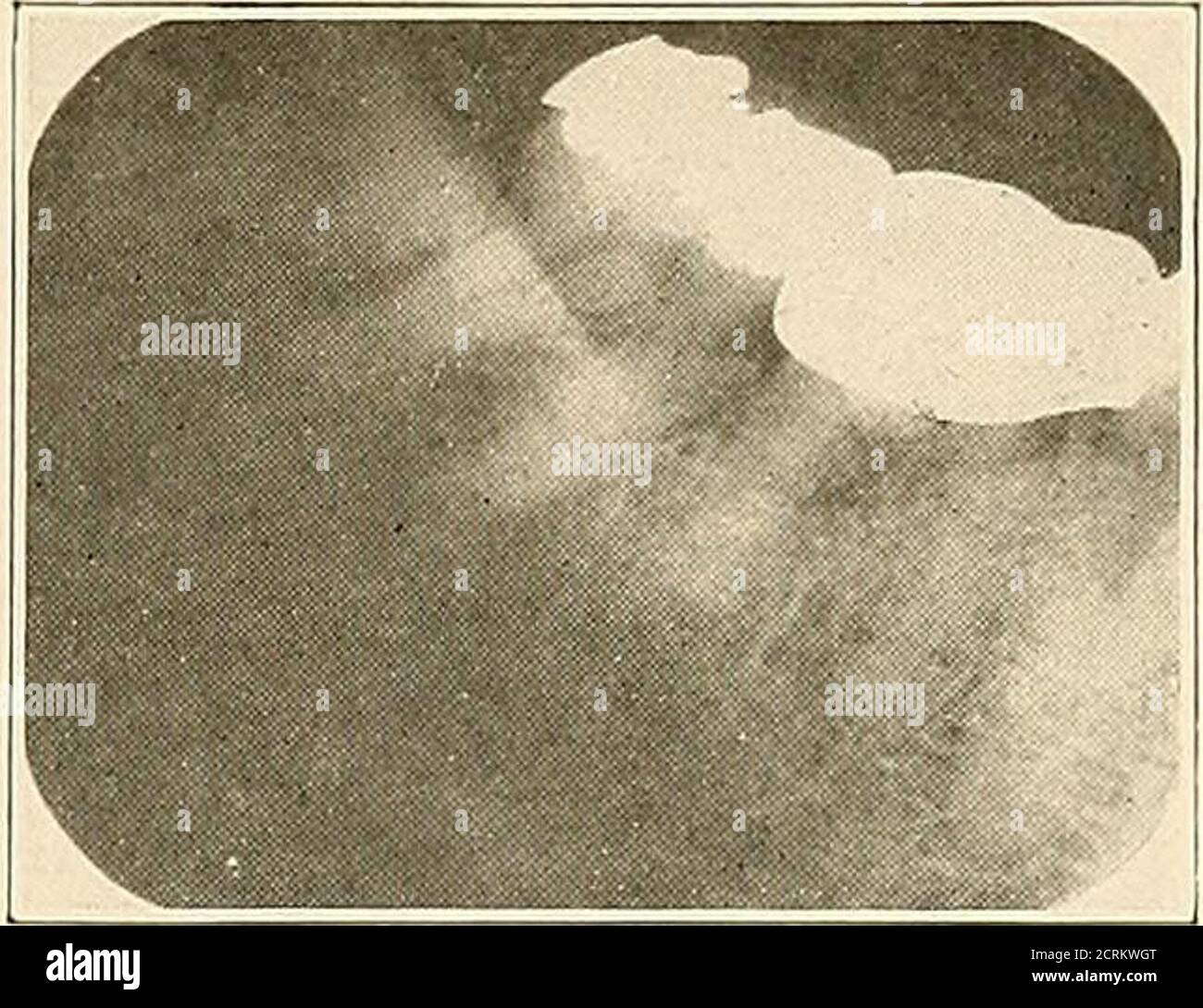 . Interpretation of dental & maxillary roentgenograms . Fig. 190. Fig ...