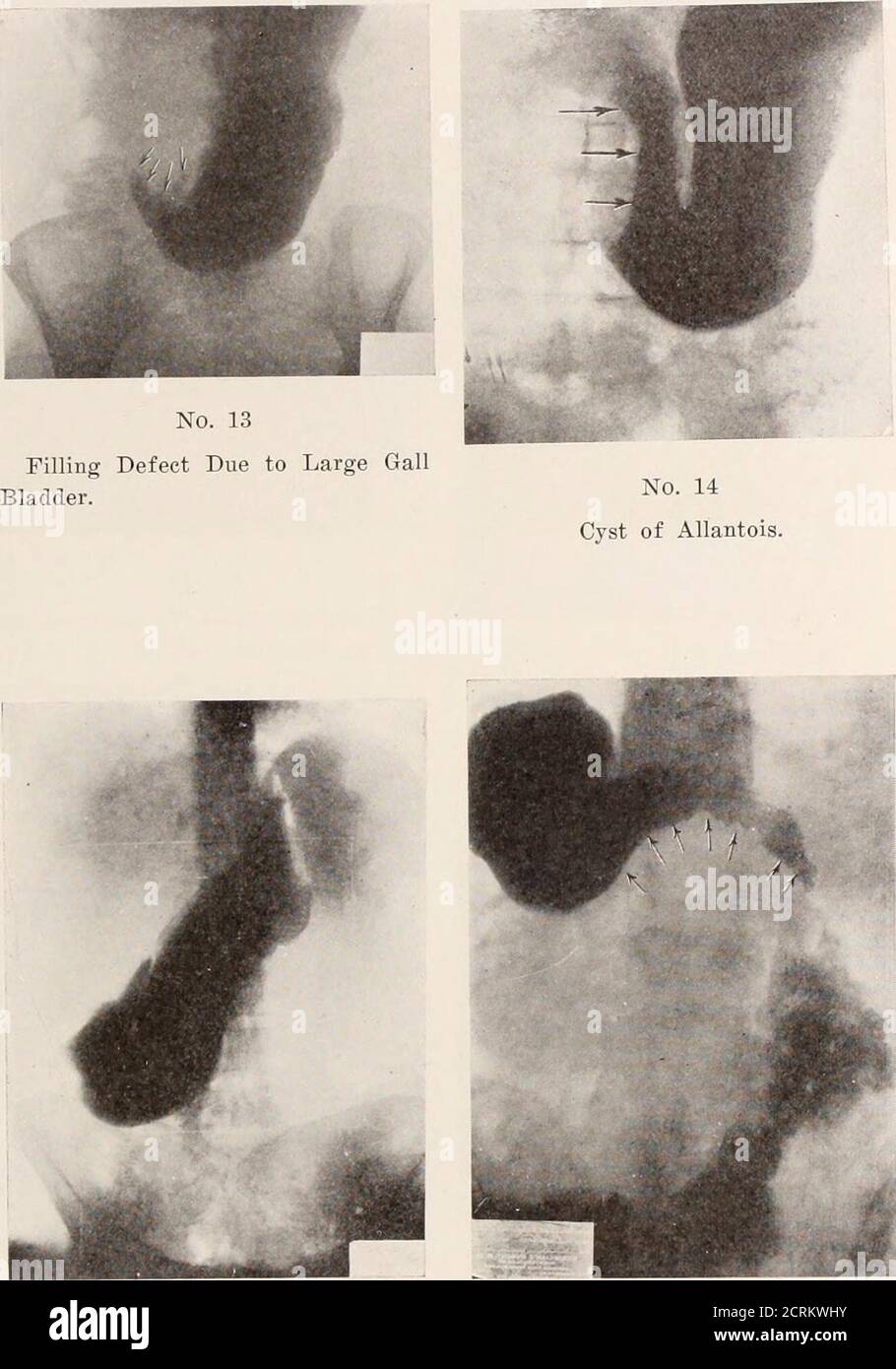 . Journal of roentgenology . No. 10 No. 12 Defect Due to Aortic ...