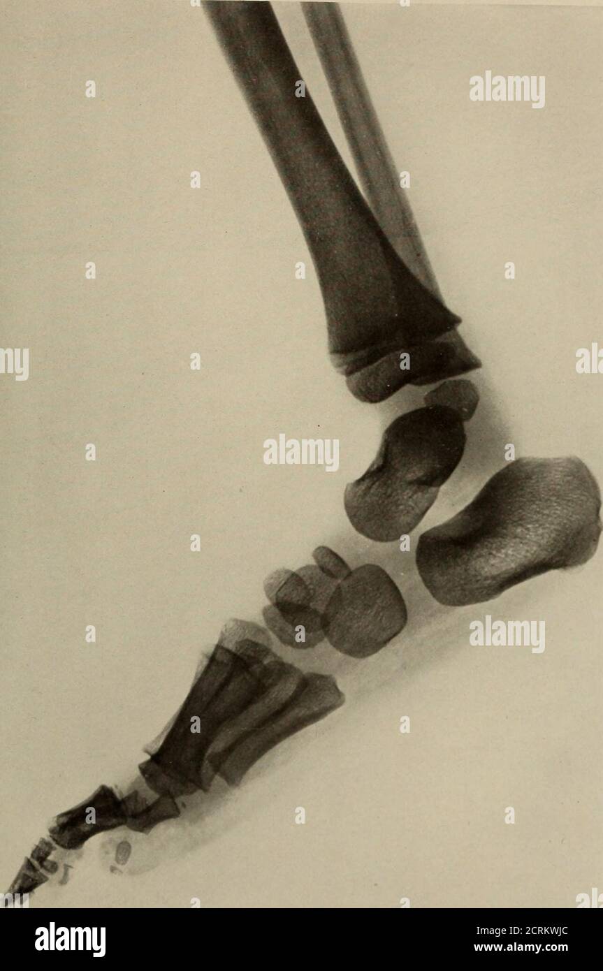 . Living anatomy and pathology; . PLATE 14.NORMAL FOOT. Child, age 5 ...