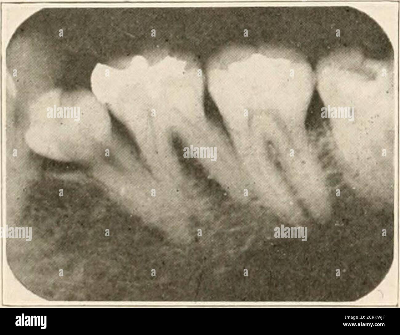 . Interpretation of dental & maxillary roentgenograms . Fig. 186. Fig ...