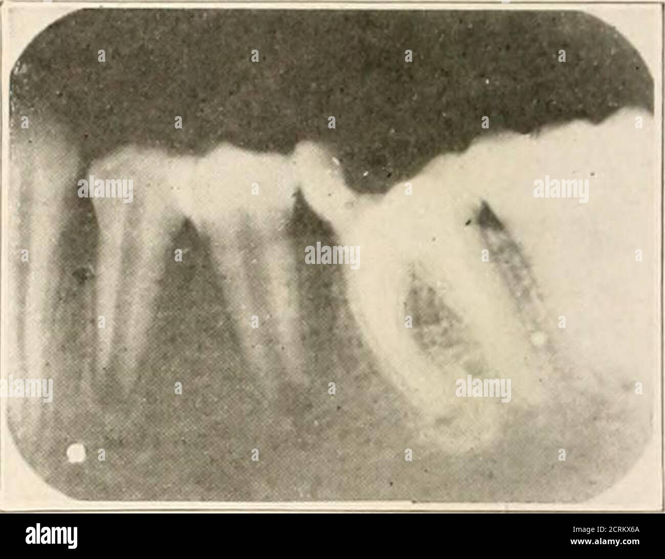 . Interpretation of dental & maxillary roentgenograms . Fig. 186. Fig ...