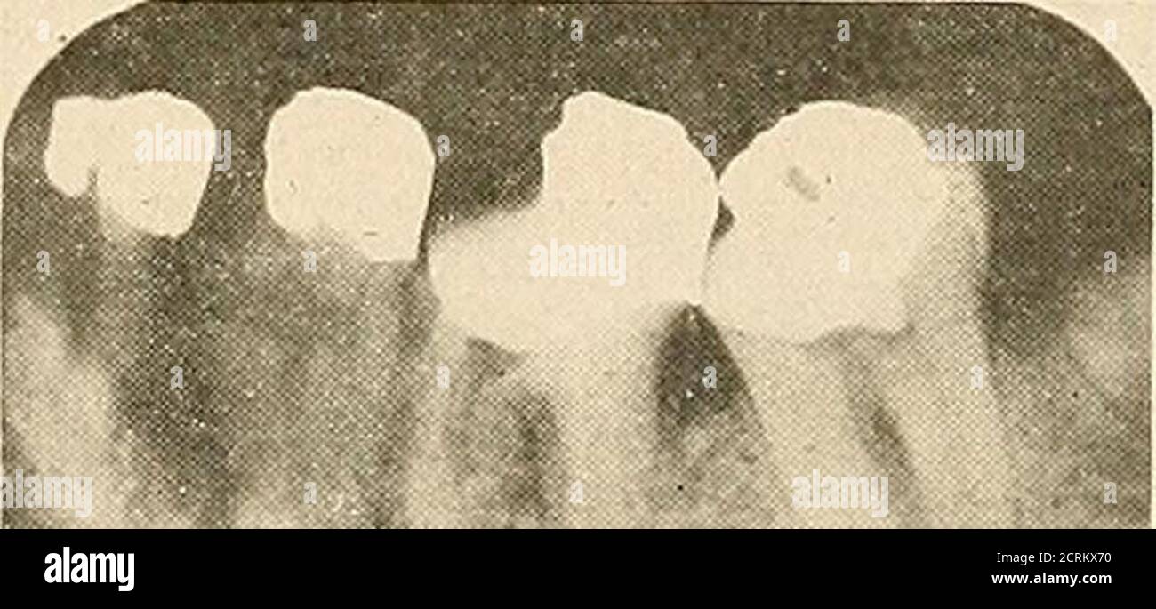. Interpretation of dental & maxillary roentgenograms . Fig. 184. Fig ...