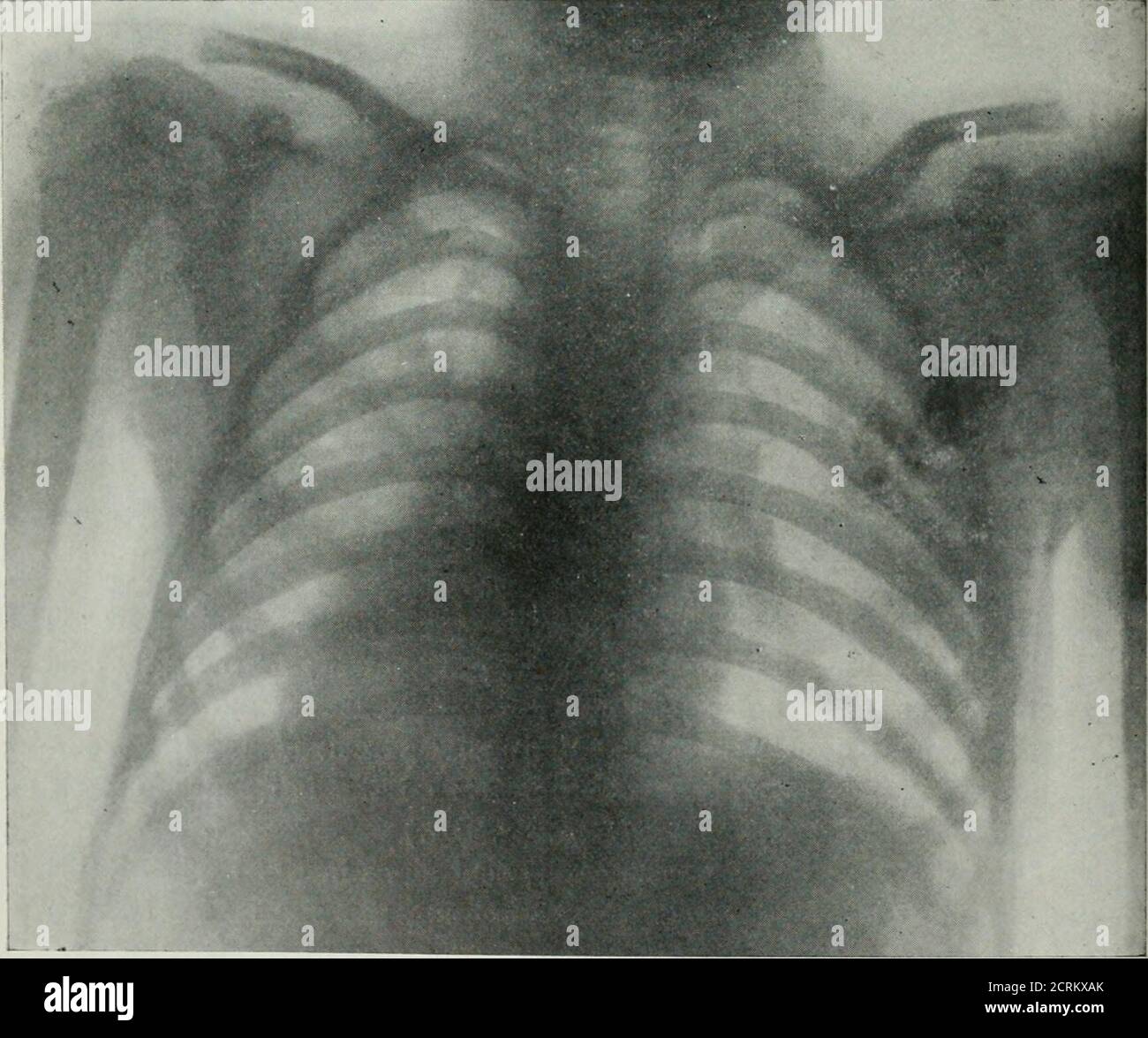 Chest x ray photograph hi-res stock photography and images - Alamy