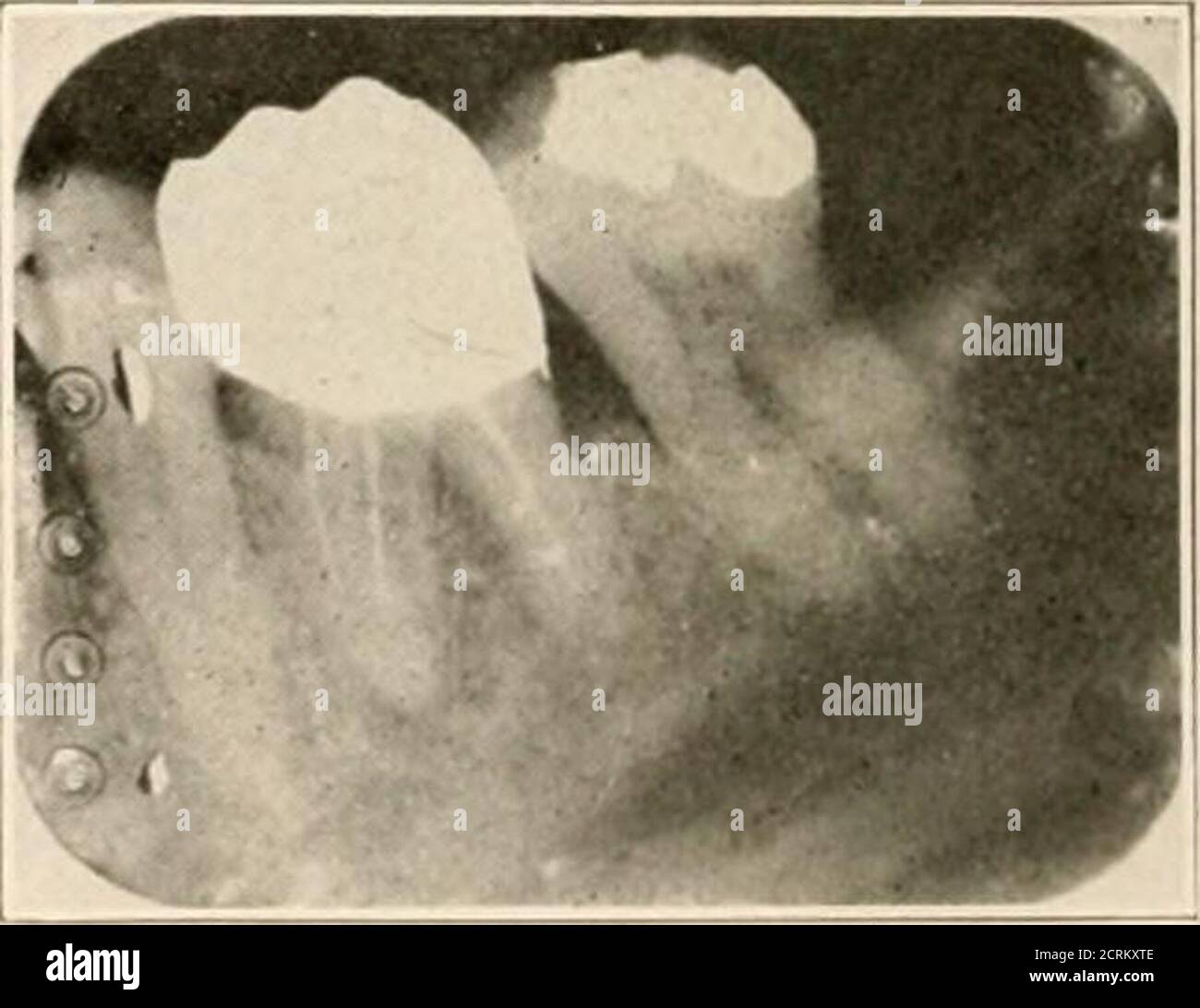 . Interpretation of dental & maxillary roentgenograms . Fig. 180. Fig ...