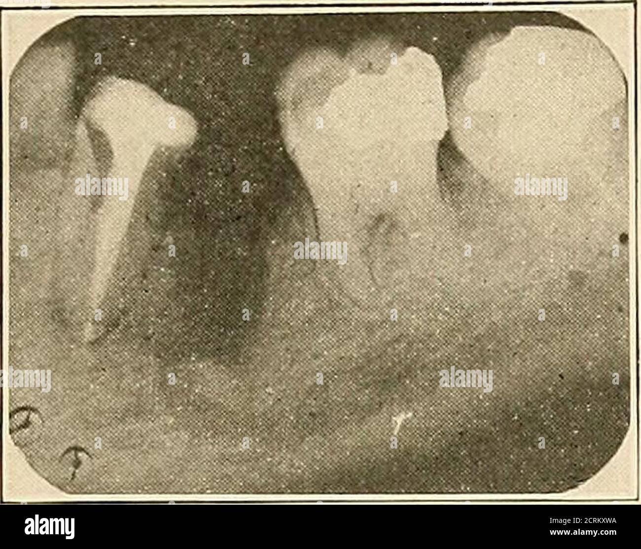 . Interpretation of dental & maxillary roentgenograms . Fig. 180. Fig ...