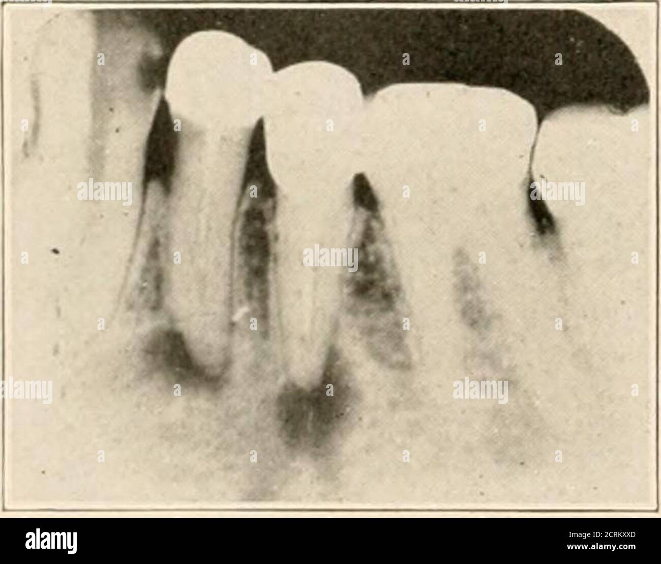 . Interpretation of dental & maxillary roentgenograms . Fig. 178. Fig ...