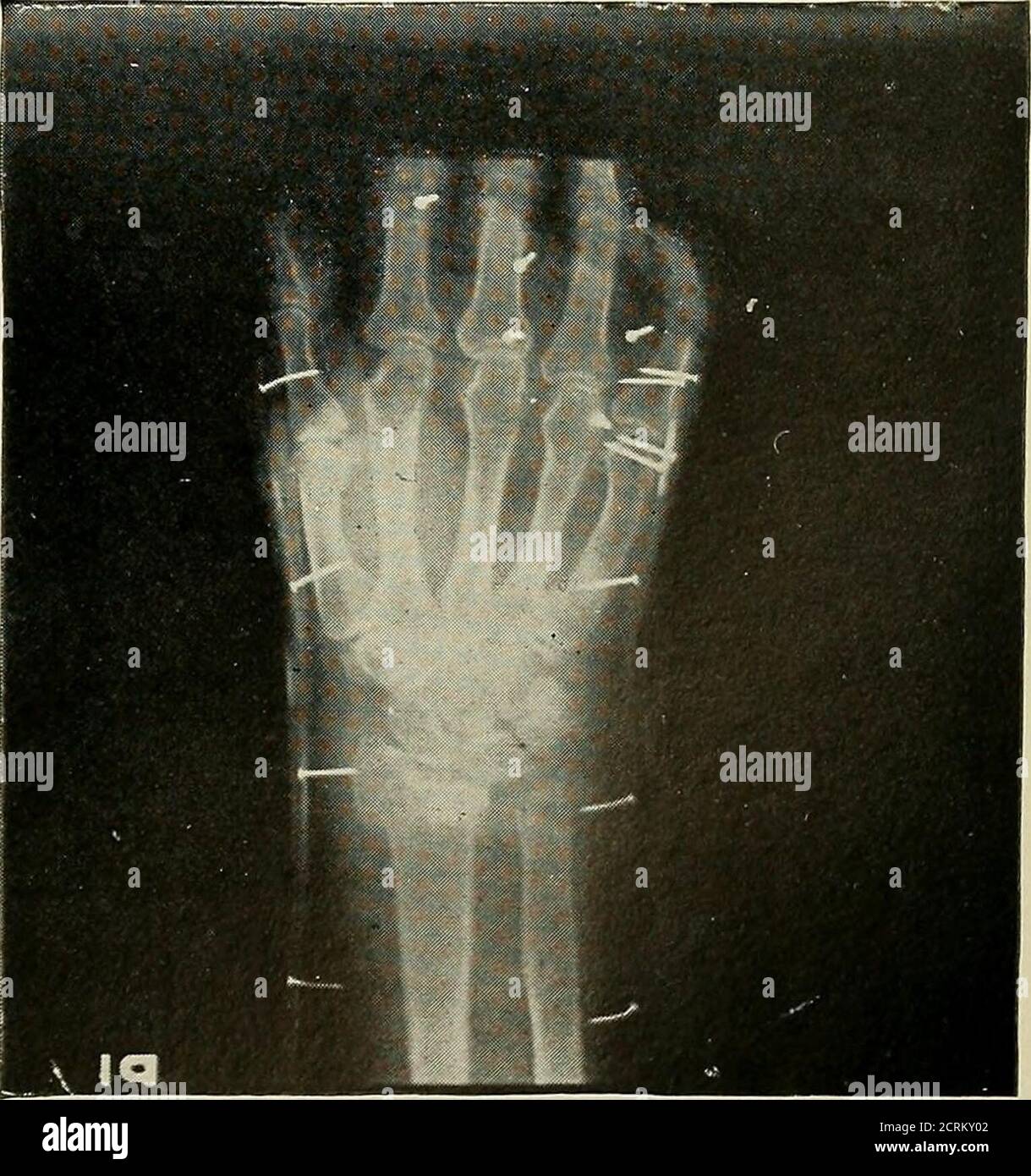 . Röntgen rays and electro-therapeutics : with chapters on radium and ...