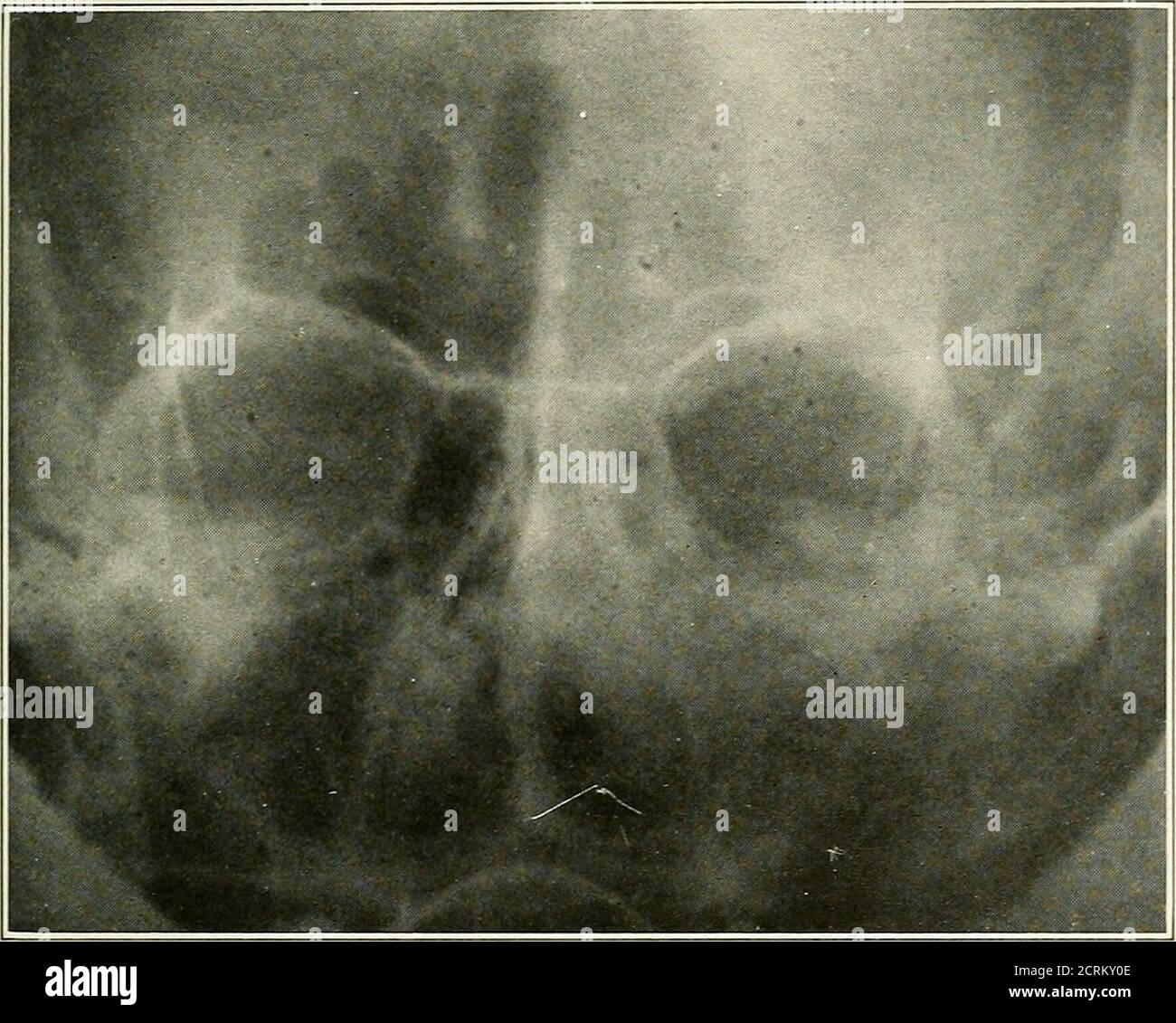 Turbinates hi-res stock photography and images - Alamy