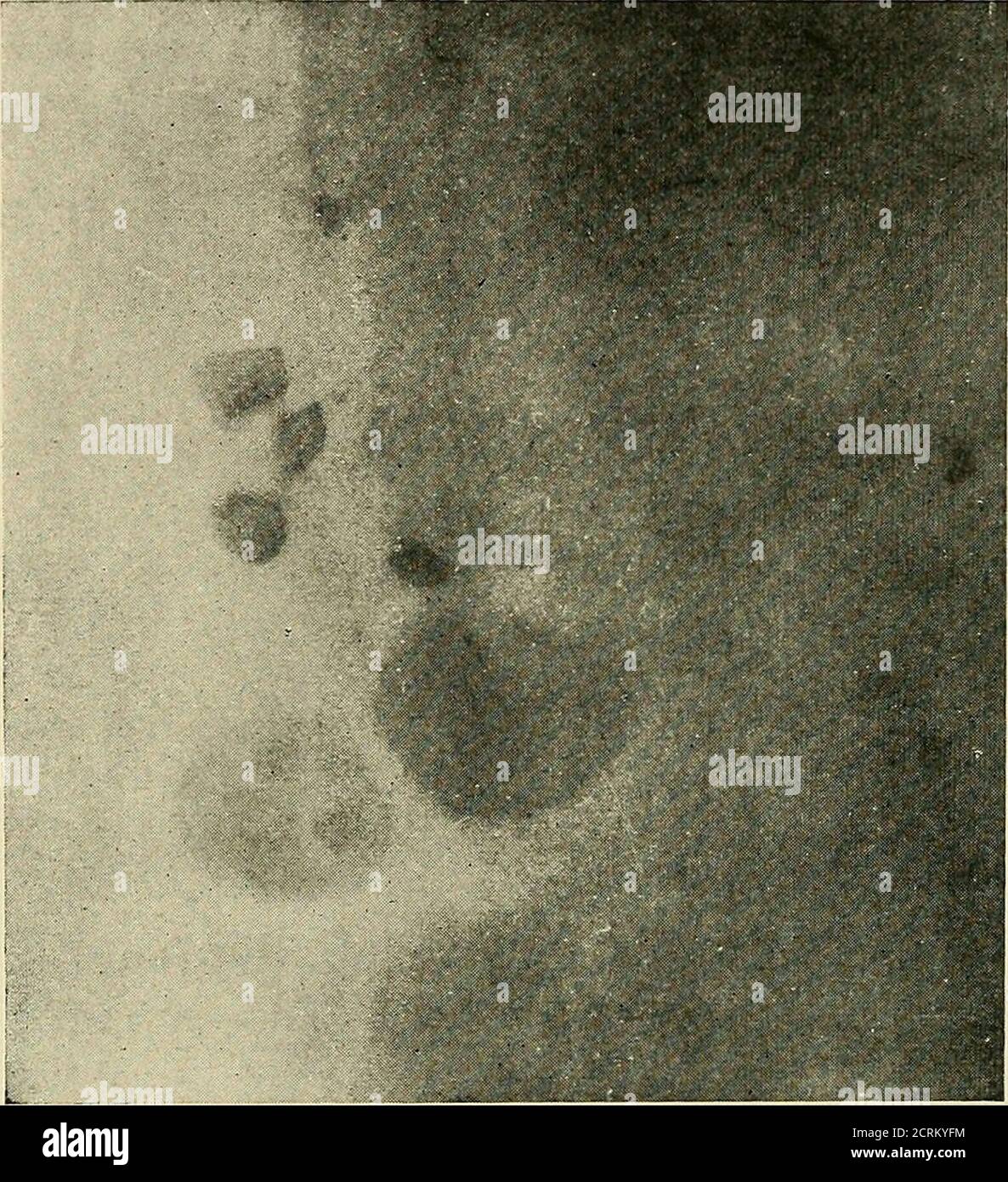 Skiagraphy hi-res stock photography and images - Alamy