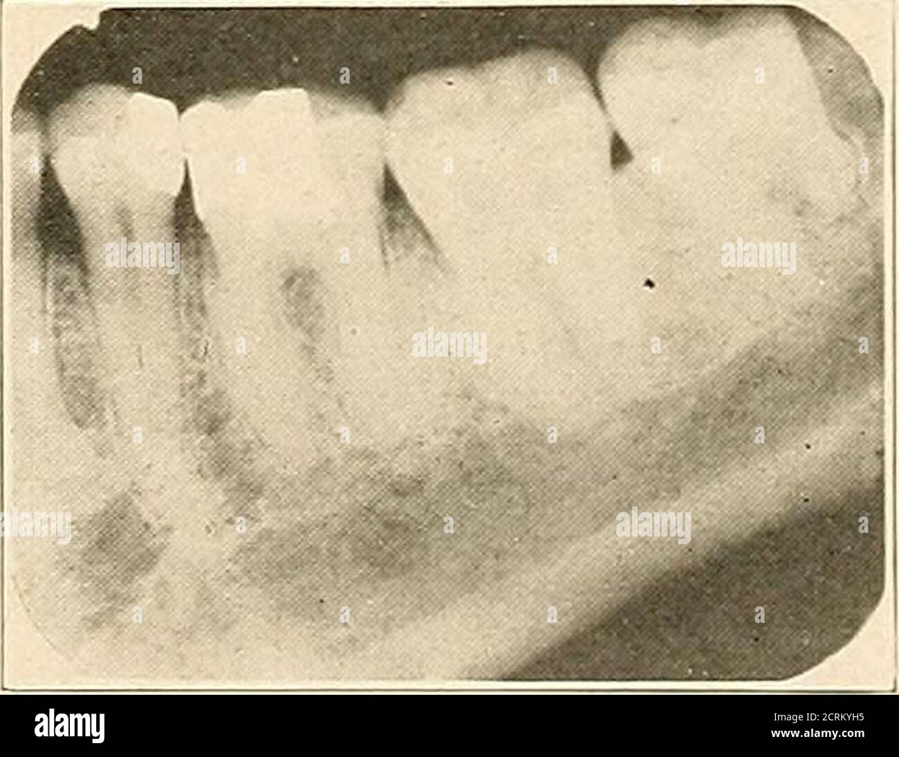 . Interpretation of dental & maxillary roentgenograms . Fig. 176. Fig ...