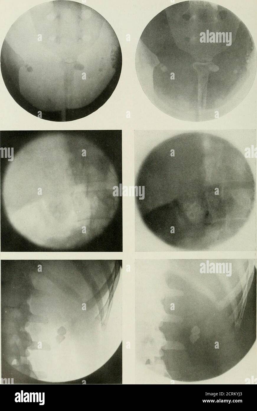 . Radiography and radio-therapeutics . PLATE LXXIV.—UuiNARY Calculi. t ...