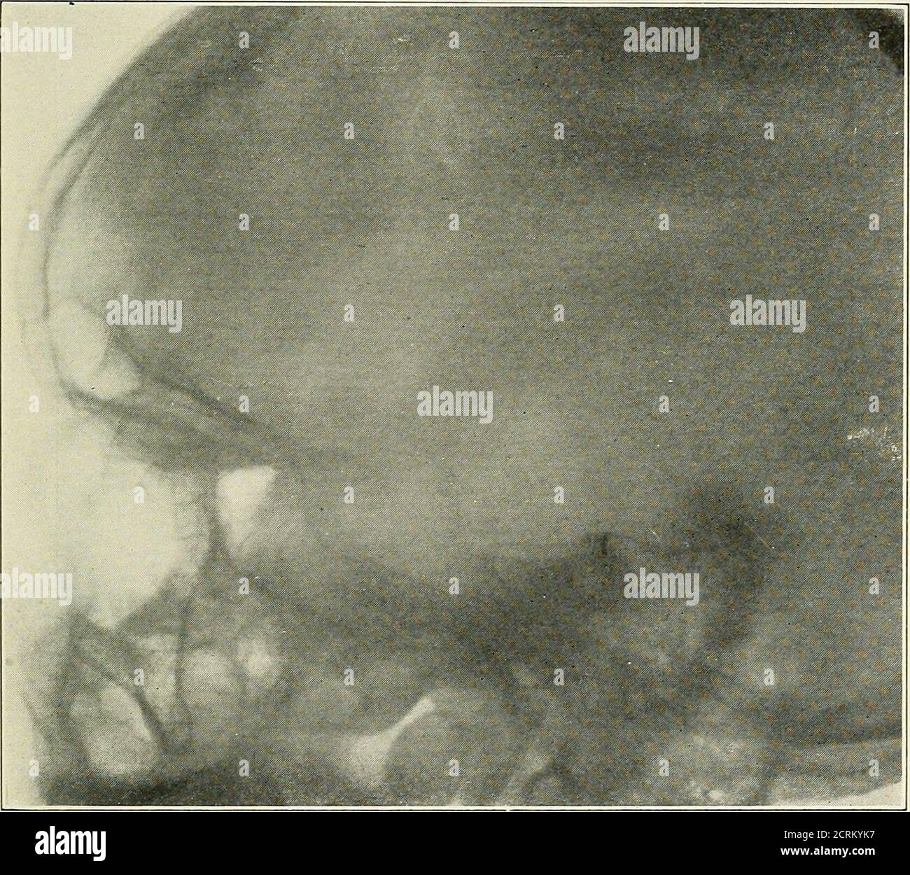 Brain calcification hi-res stock photography and images - Alamy