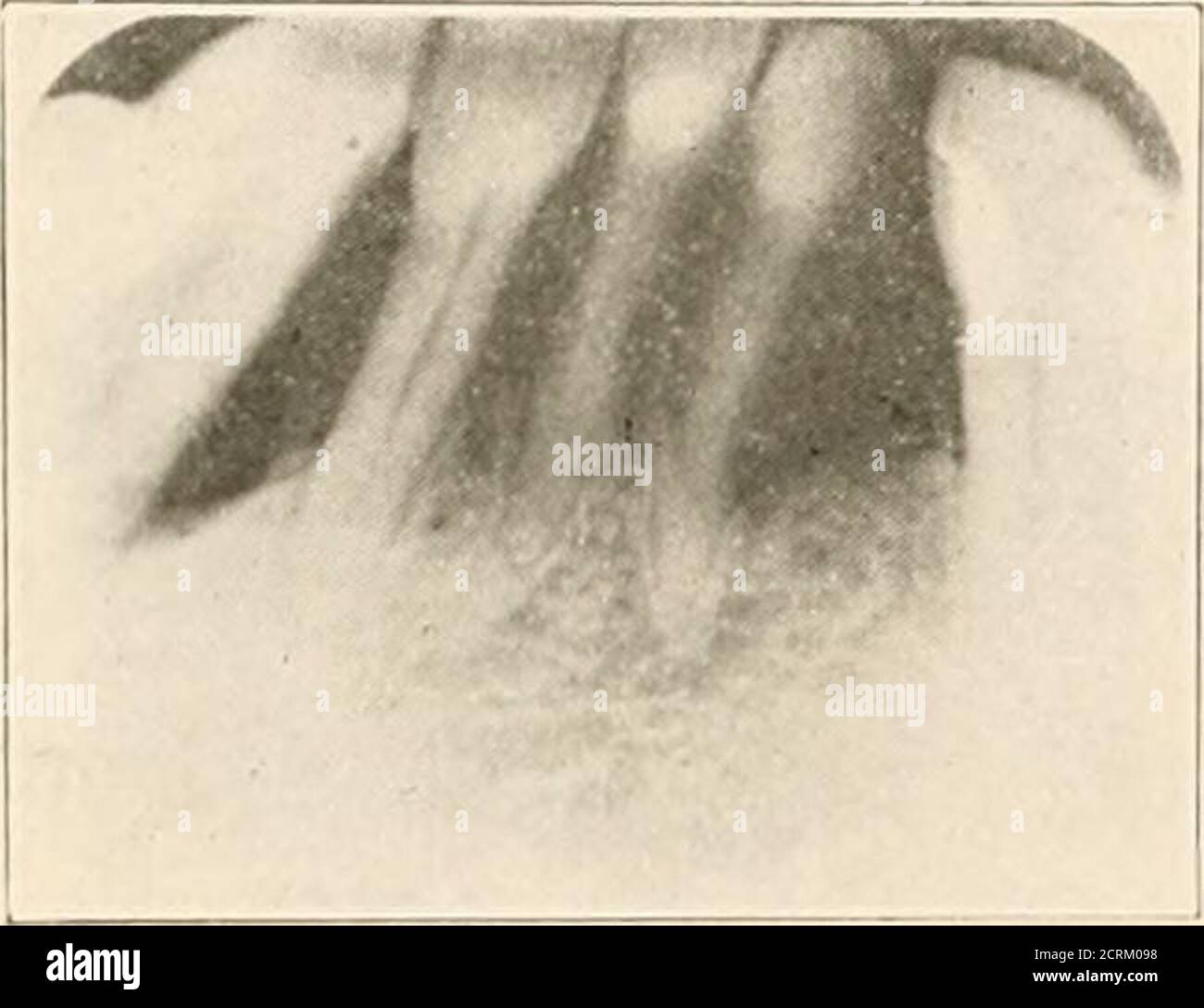 . Interpretation of dental & maxillary roentgenograms . Fig. 170. Fig ...