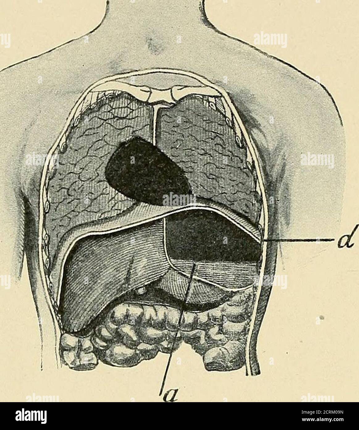 Subphrenic abscess hi-res stock photography and images - Alamy