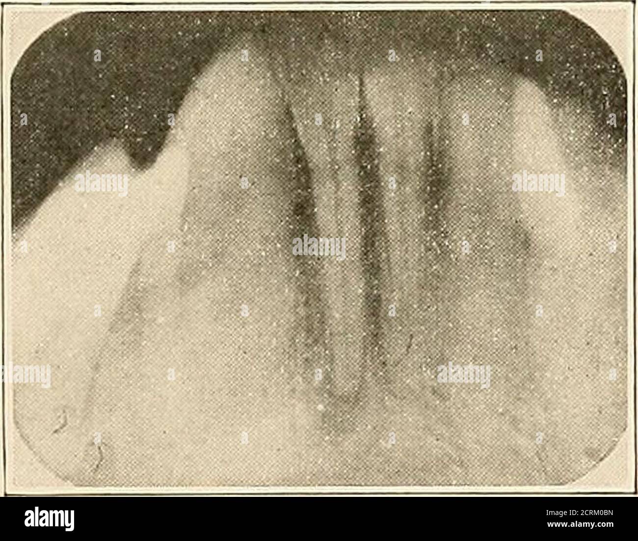 . Interpretation of dental & maxillary roentgenograms . Fig. 166. Fig ...