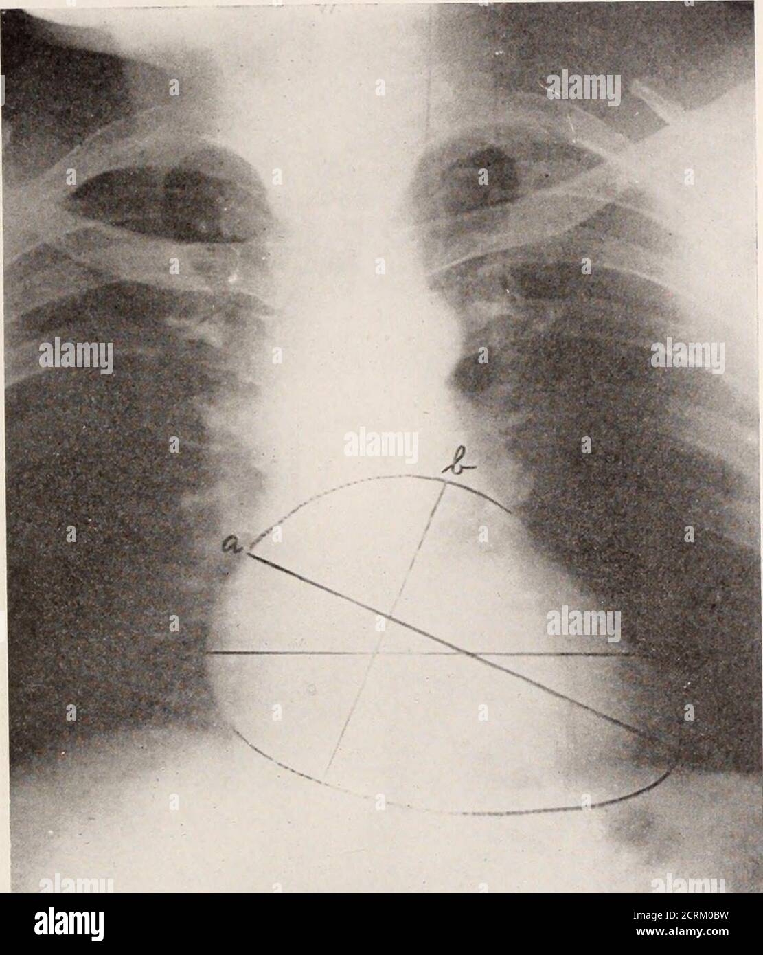 . Journal of roentgenology . la. Male. Normal heart. Showing method of ...