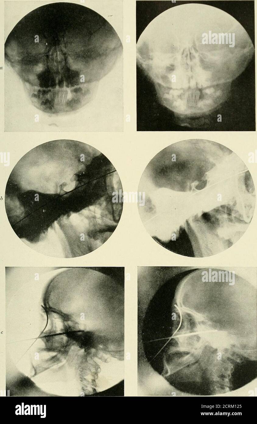 Frontal x ray of skull showing sinuses hi-res stock photography and ...