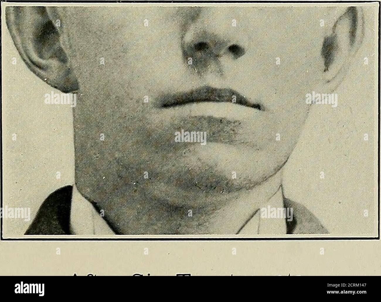 Sycosis hi-res stock photography and images - Alamy