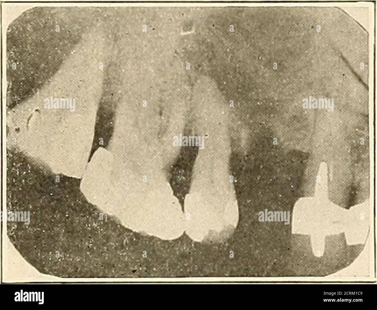 . Interpretation of dental & maxillary roentgenograms . Fig. 158. Fig ...