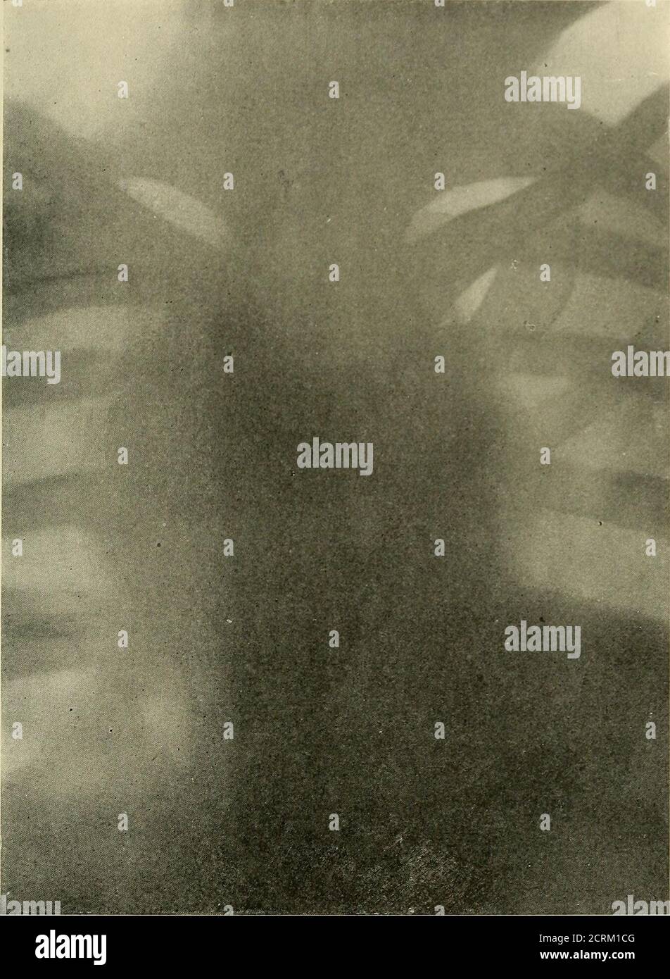 Supraclavicular fossa hi-res stock photography and images - Alamy