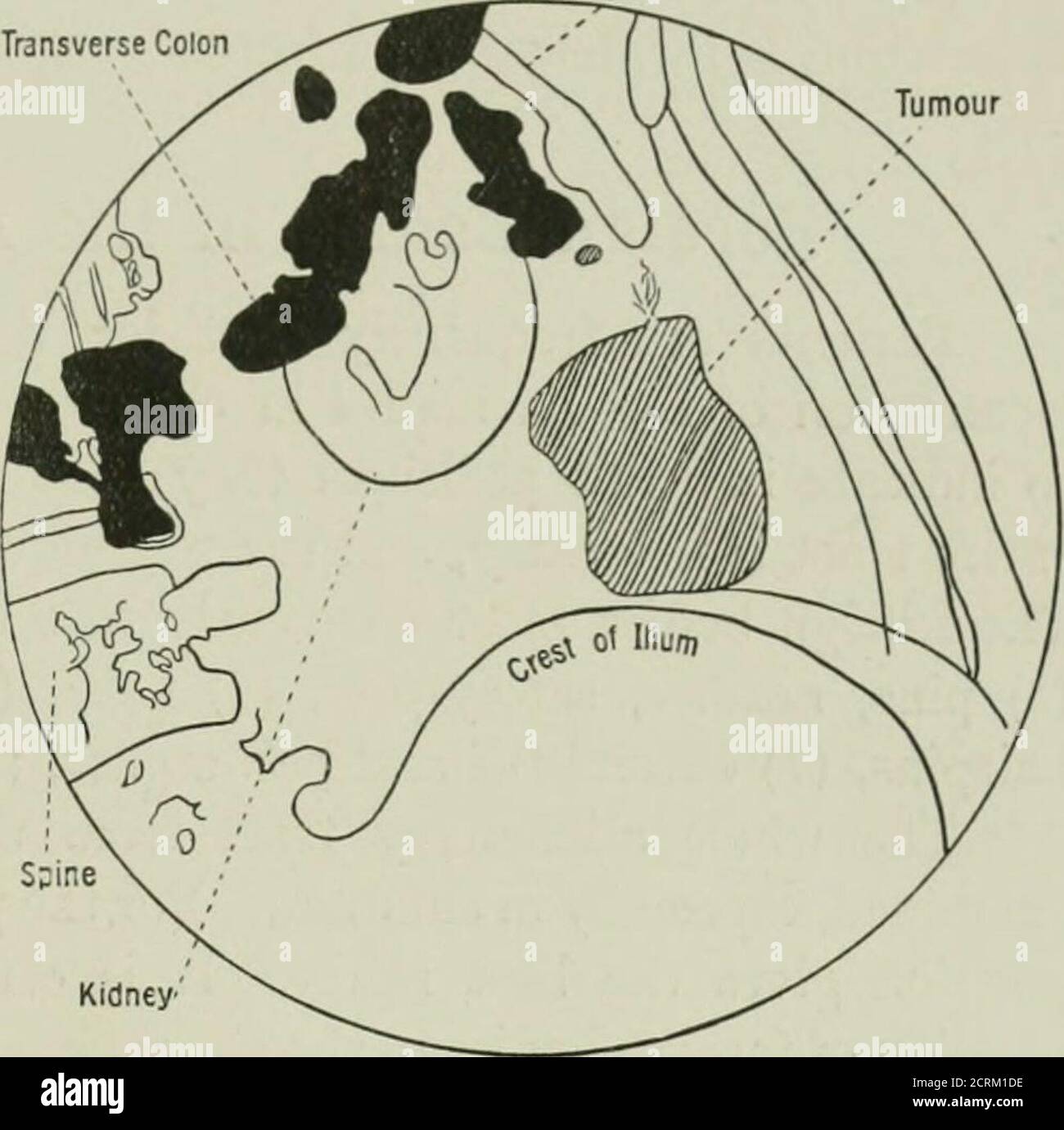 . Radiography and radio-therapeutics . Fifi. 310.—Dilatation due to ...