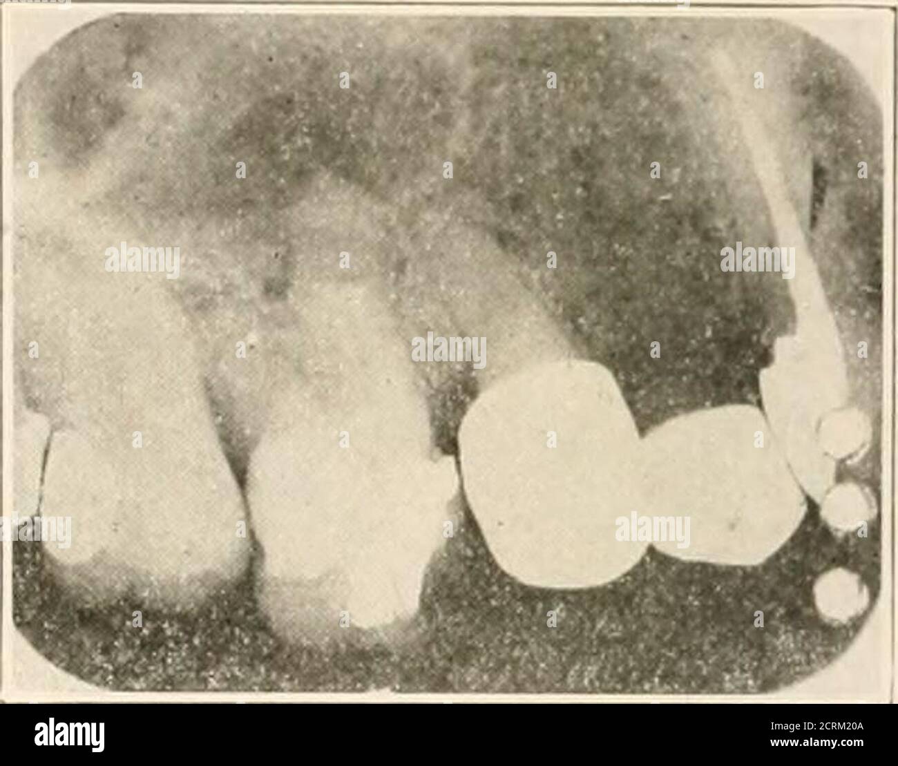 . Interpretation of dental & maxillary roentgenograms . Fig. 154. Fig ...