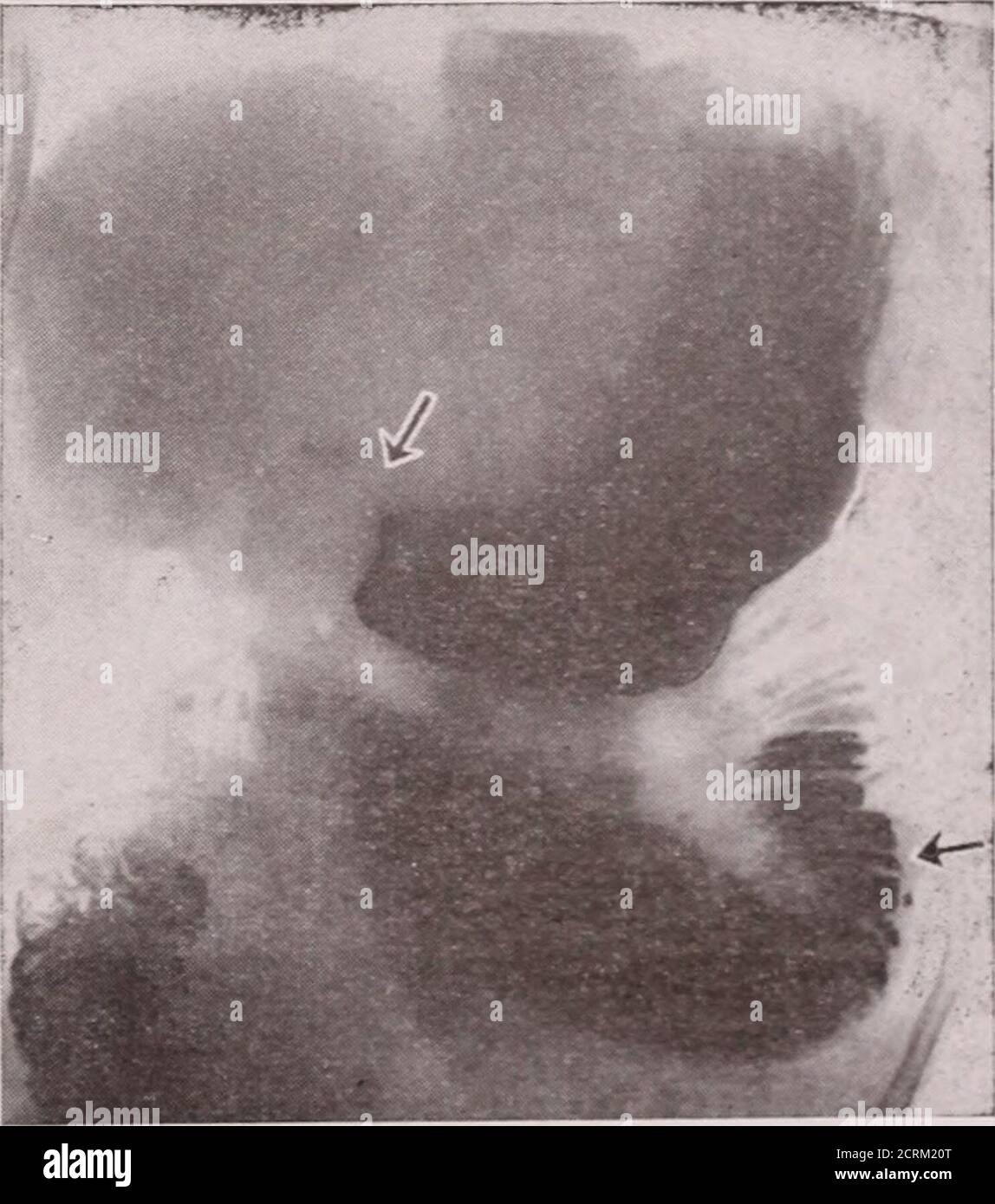 Hematemesis hi-res stock photography and images - Alamy