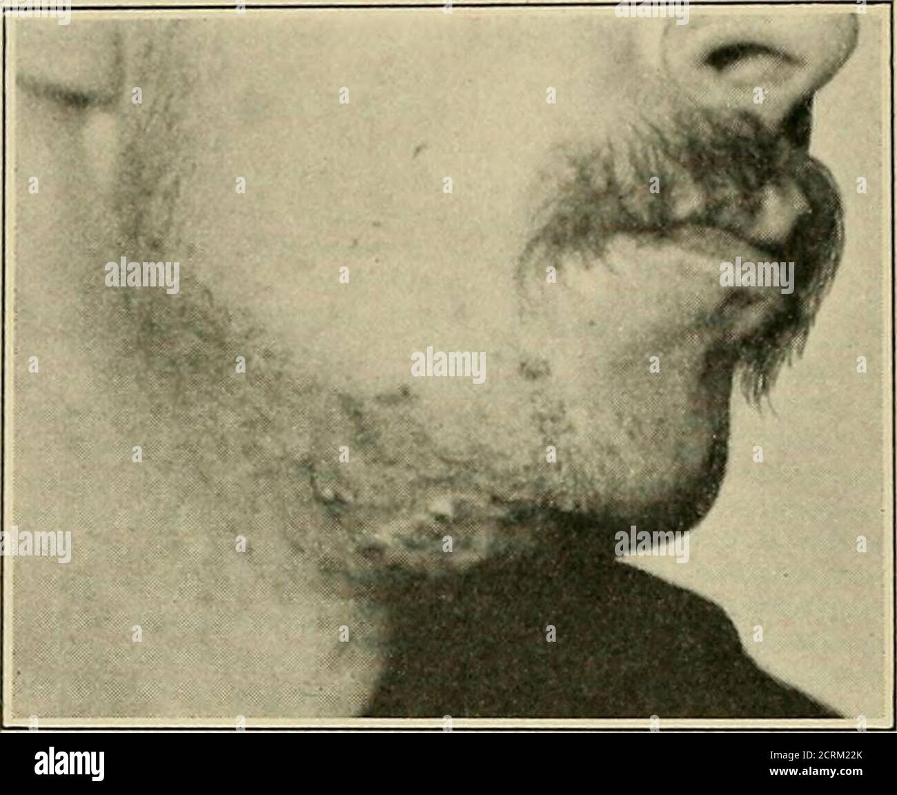 Sycosis hi-res stock photography and images - Alamy