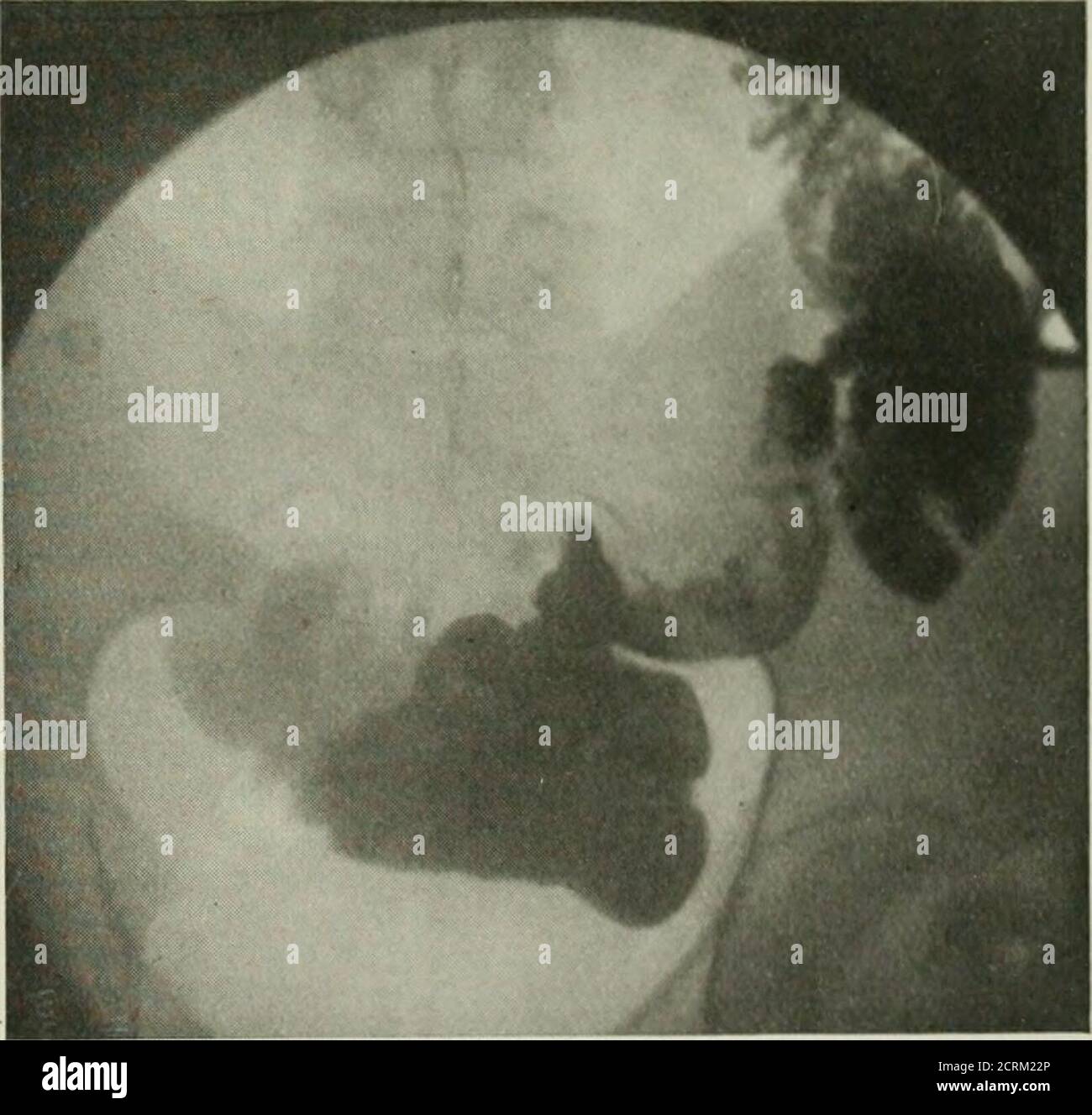 . Radiography and radio-therapeutics . e / !, 7, Fig. 306.—Illustrating ...