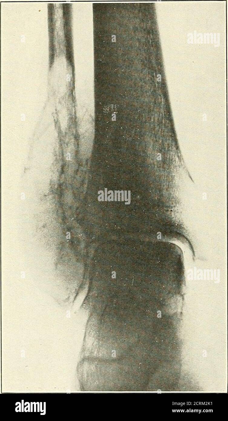 Soft tissue sarcoma hi-res stock photography and images - Alamy