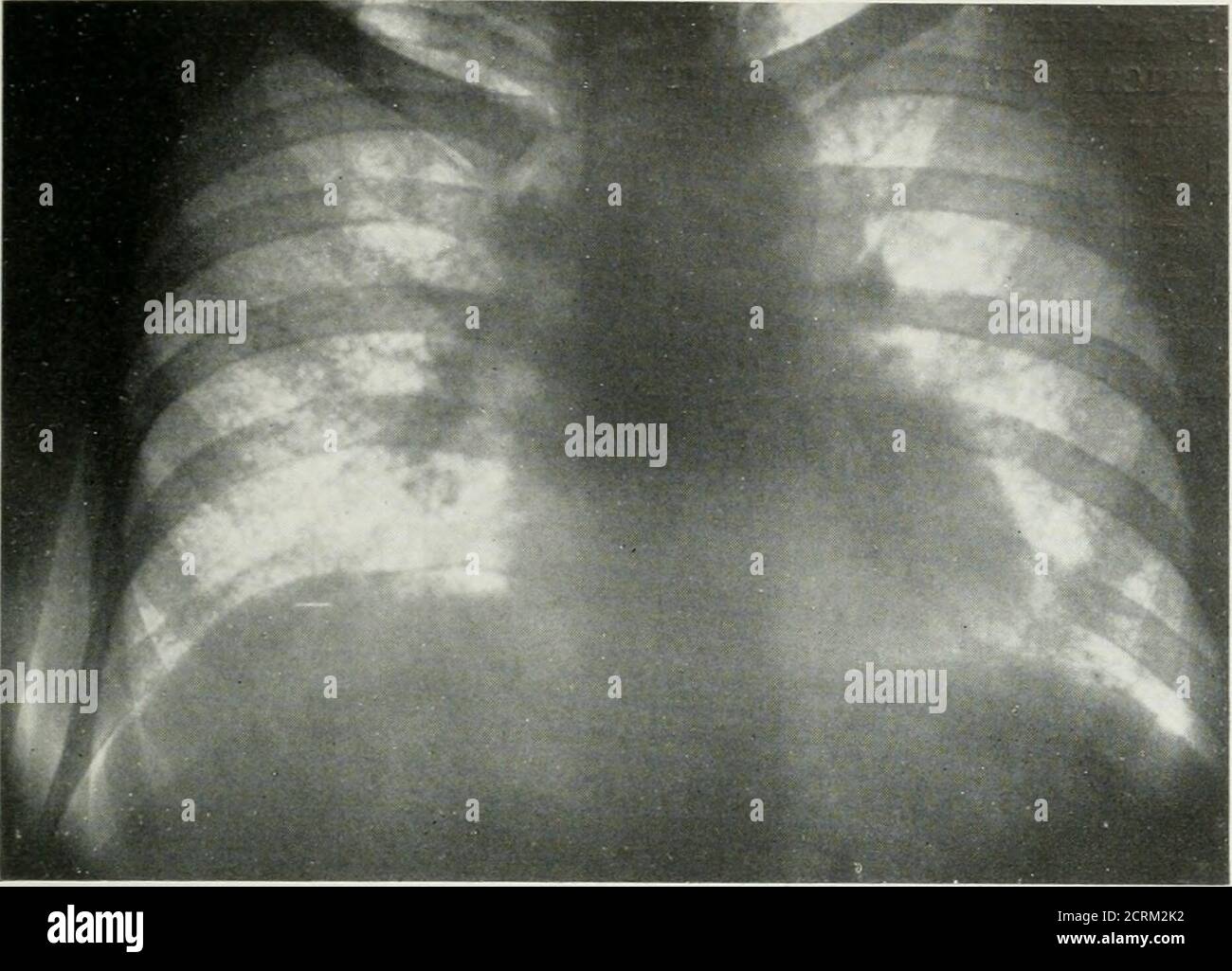 Anthracosis hi-res stock photography and images - Alamy