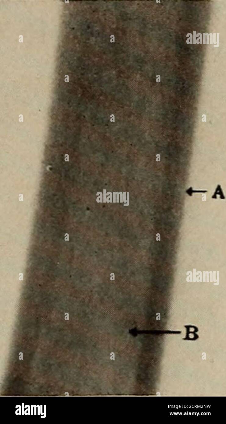 . Living anatomy and pathology; . Medulla. Fig. 2. The Diaphyses of a ...