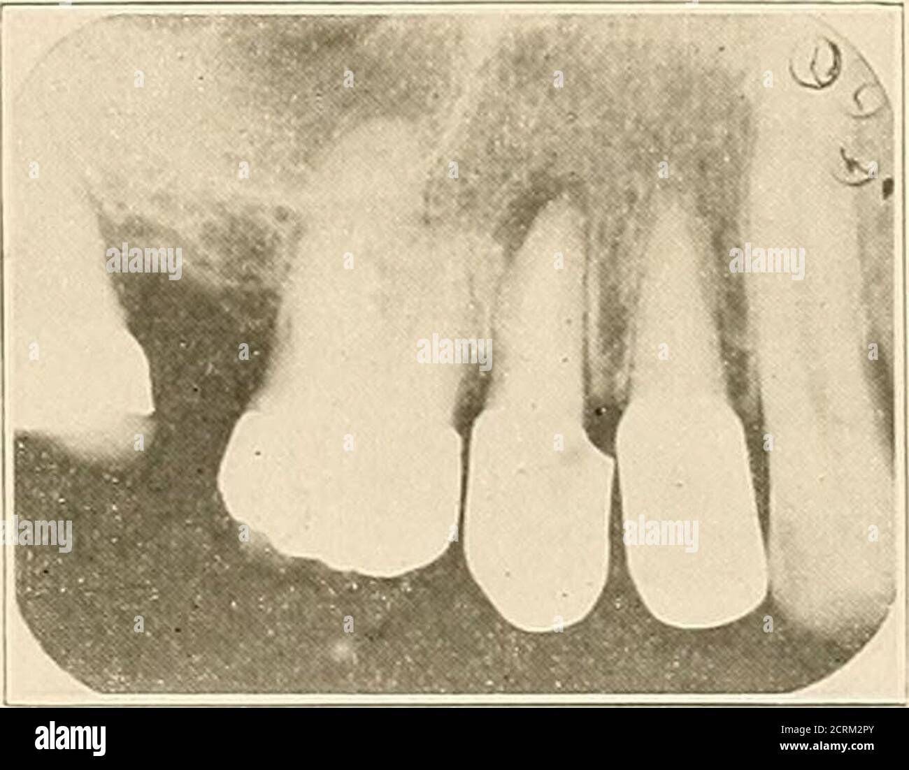 . Interpretation of dental & maxillary roentgenograms . Fig. 150. Fig ...