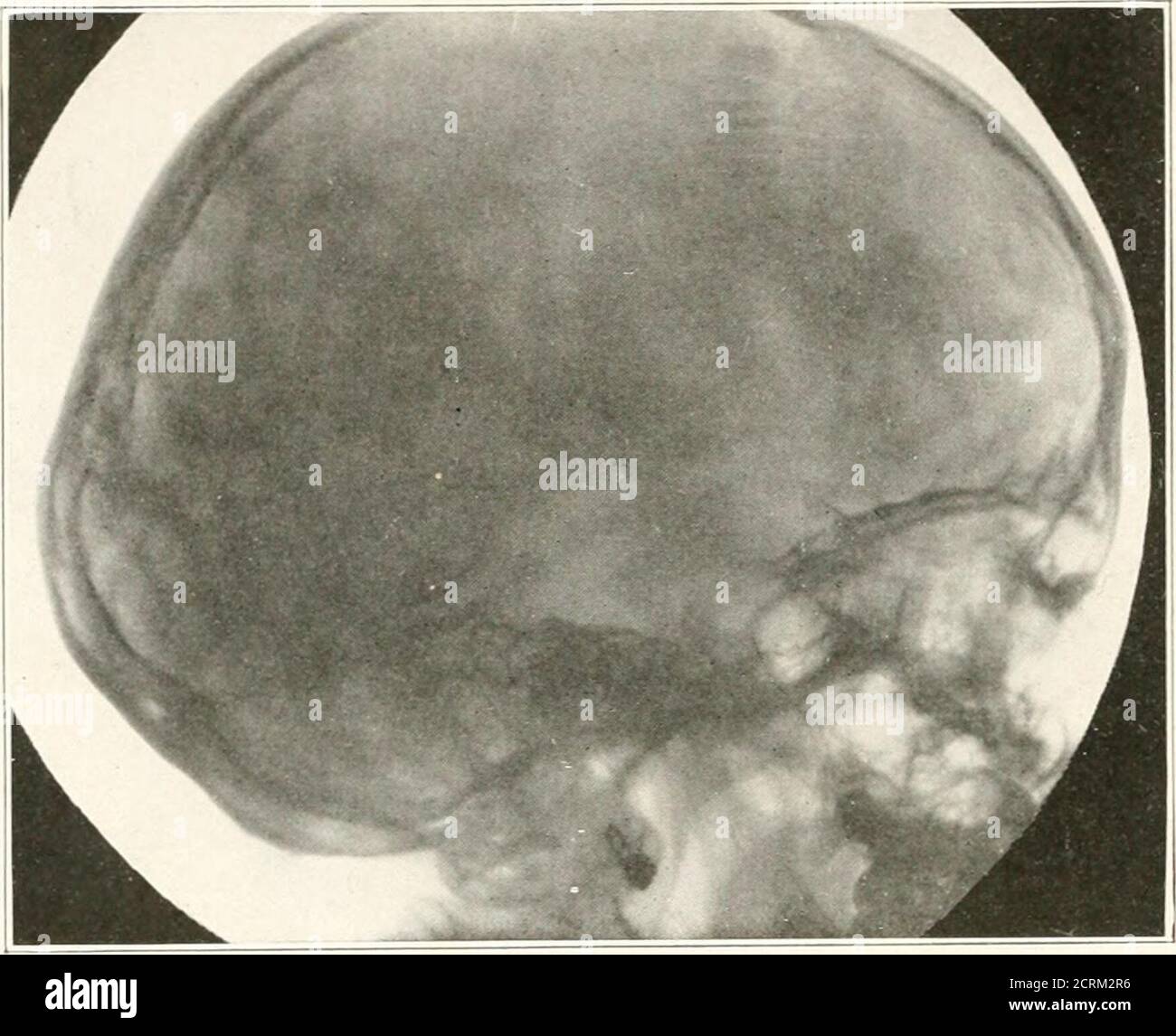 . Roentgen diagnosis of diseases of the head . ering the prominence of ...