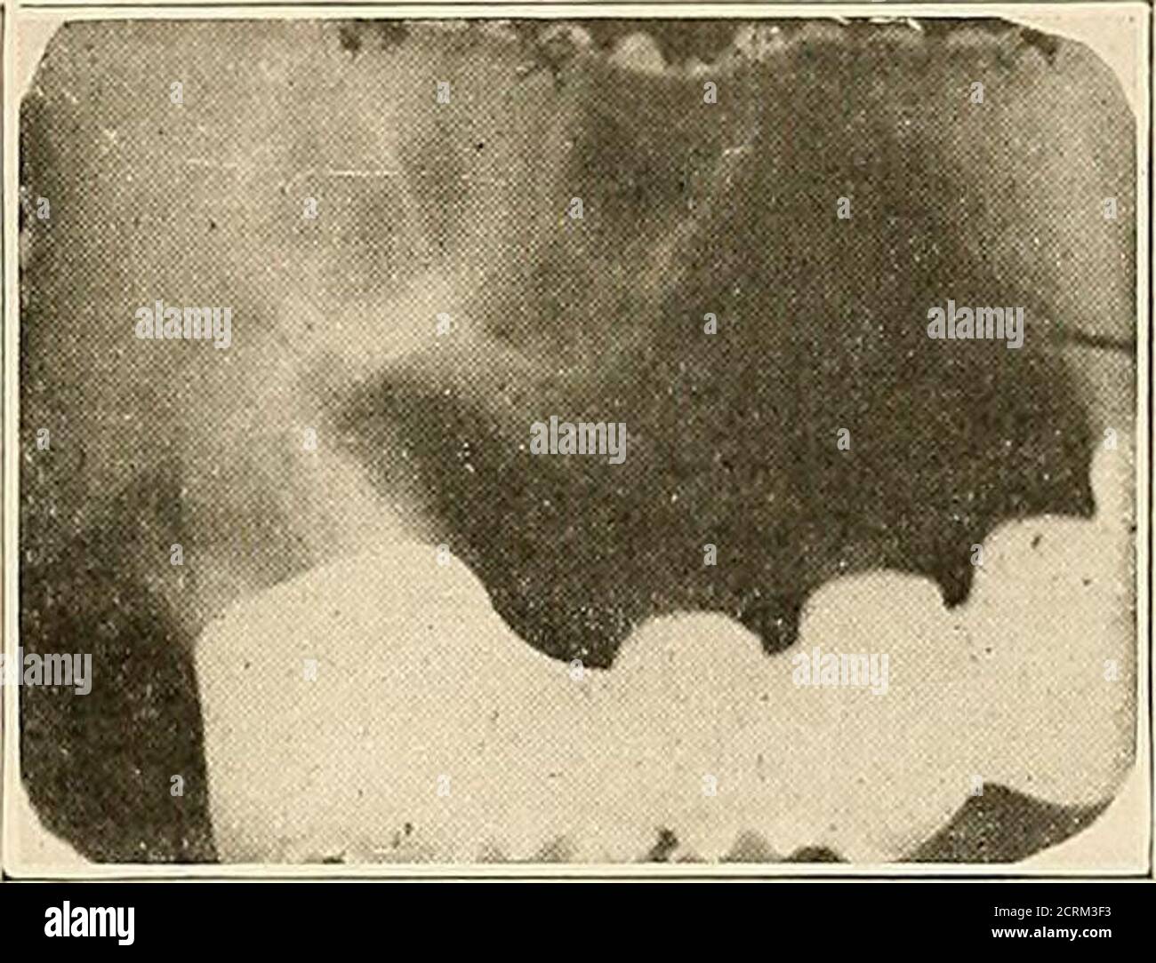 Maxillary first molar hi-res stock photography and images - Alamy