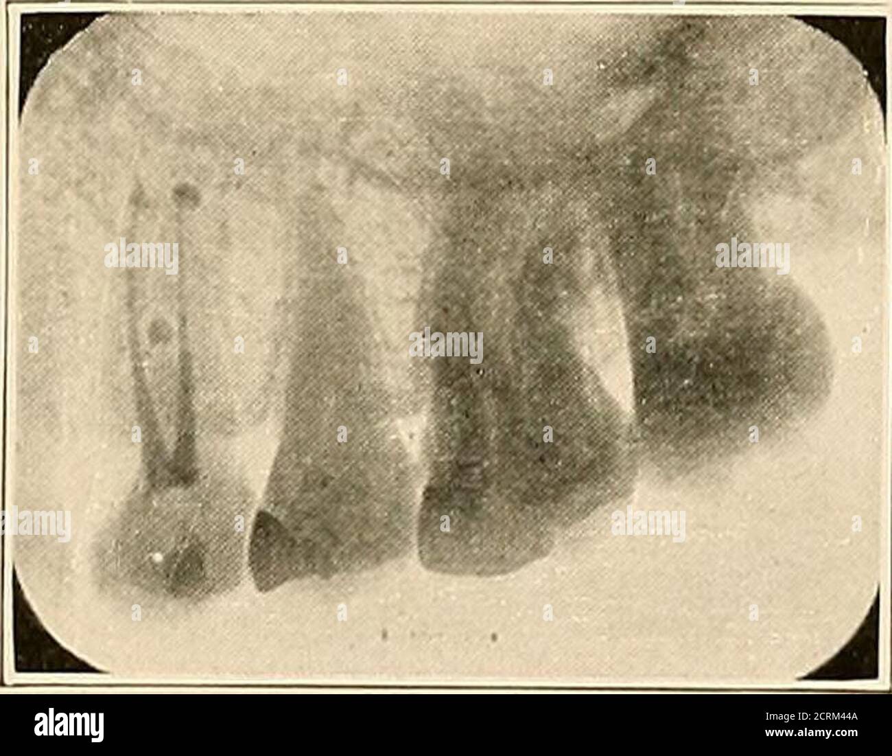 . Oral sepsis in its relationship to systemic disease . Fig. 156. Fig ...