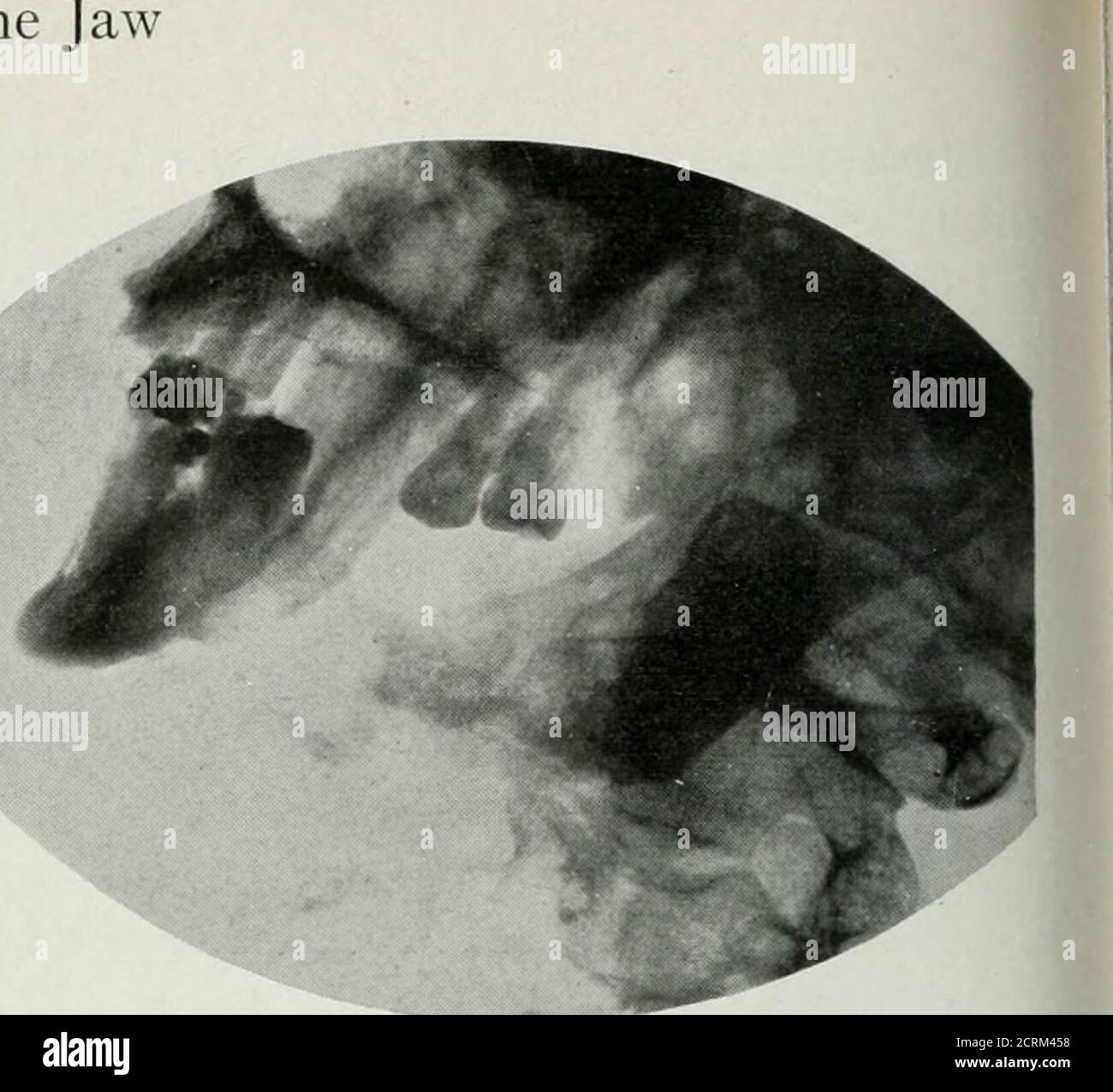 Invasive carcinoma hi-res stock photography and images - Alamy