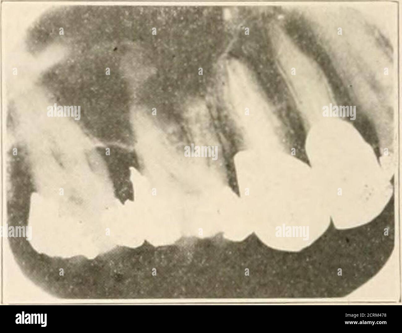 . Interpretation of dental & maxillary roentgenograms . Fig. 138. Fig ...