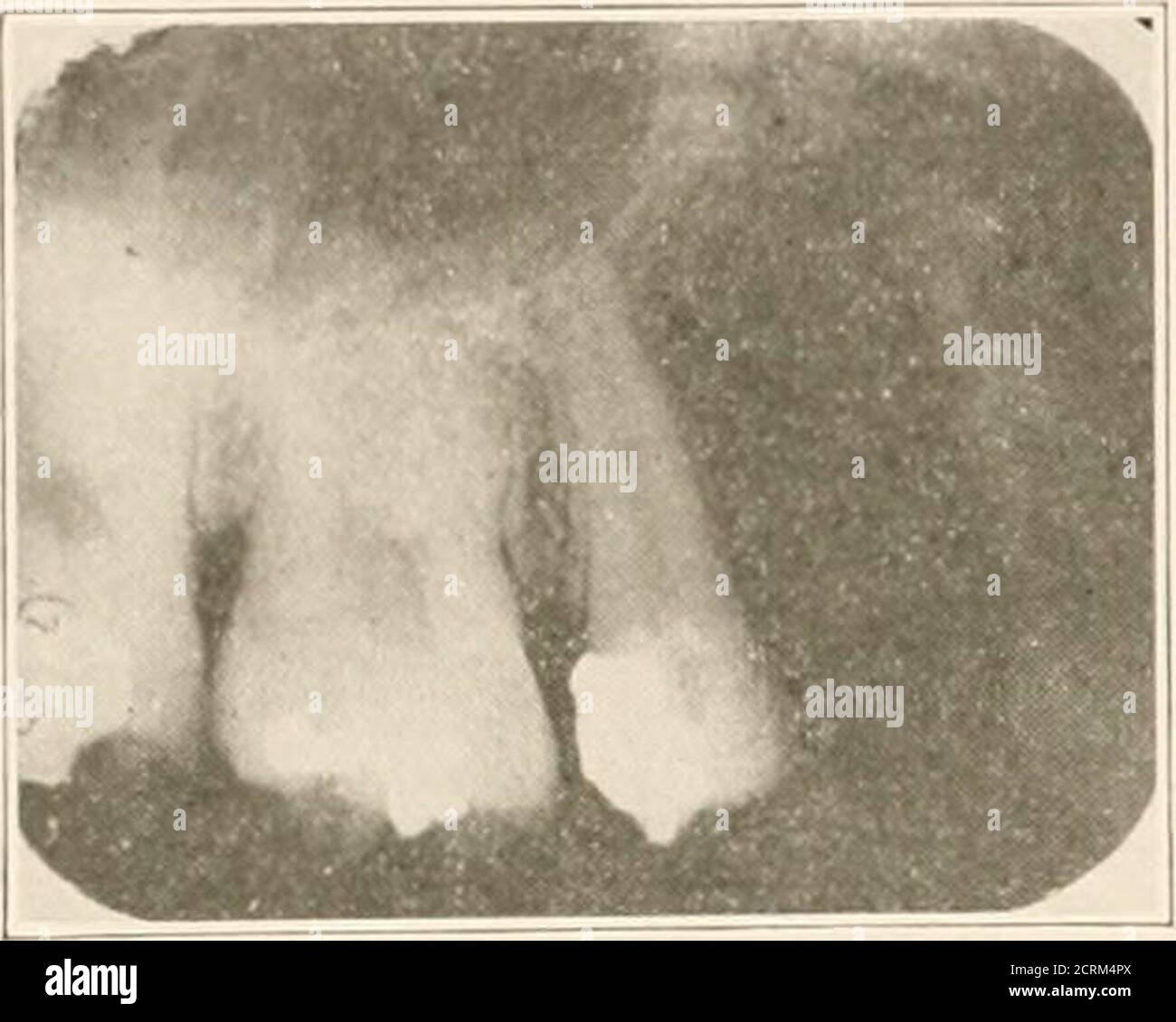 . Interpretation of dental & maxillary roentgenograms . Fig. 128. Fig ...