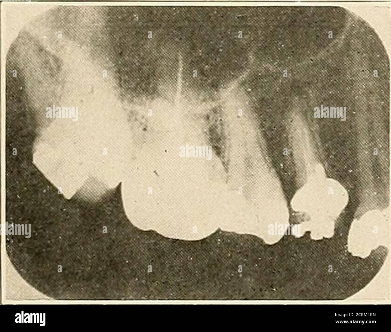 Maxillary fracture hi-res stock photography and images - Alamy